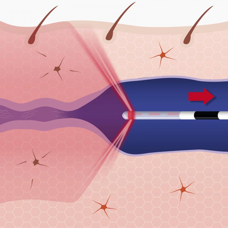 The technique of endovenous laser simLa® 6